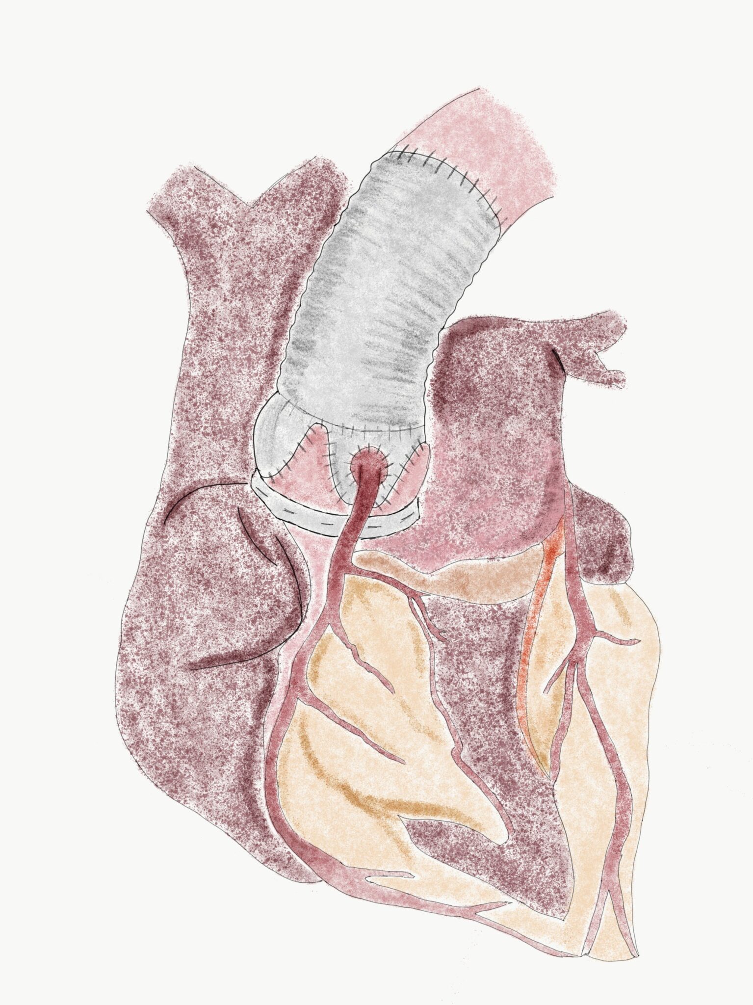 Aortic ring replacement - Medical Horizons